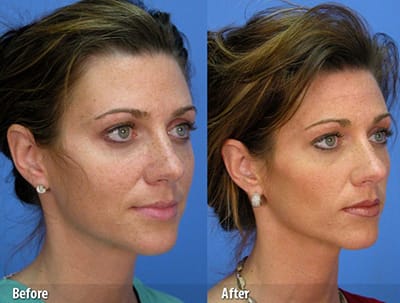 Micro Laser Peel San Diego | Micro Laser Peel La Jolla, CA