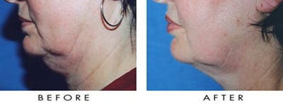 Titan Laser San Diego | Titan Laser La Jolla, CA